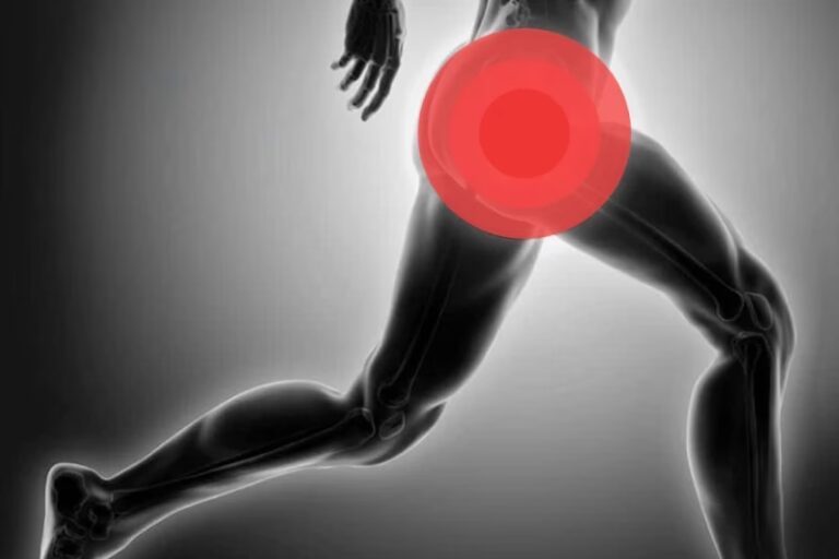 ¿Dolor de Cadera? Identifica Síntomas y Causas | Salud & Movimiento